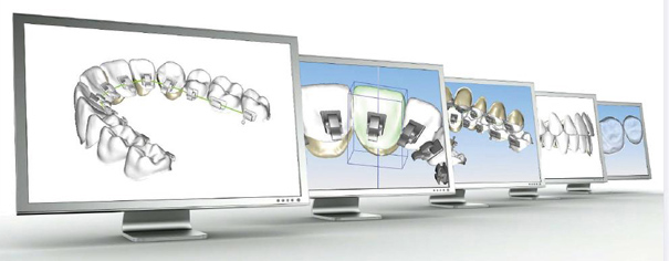 Aparat Dentar Invizibil